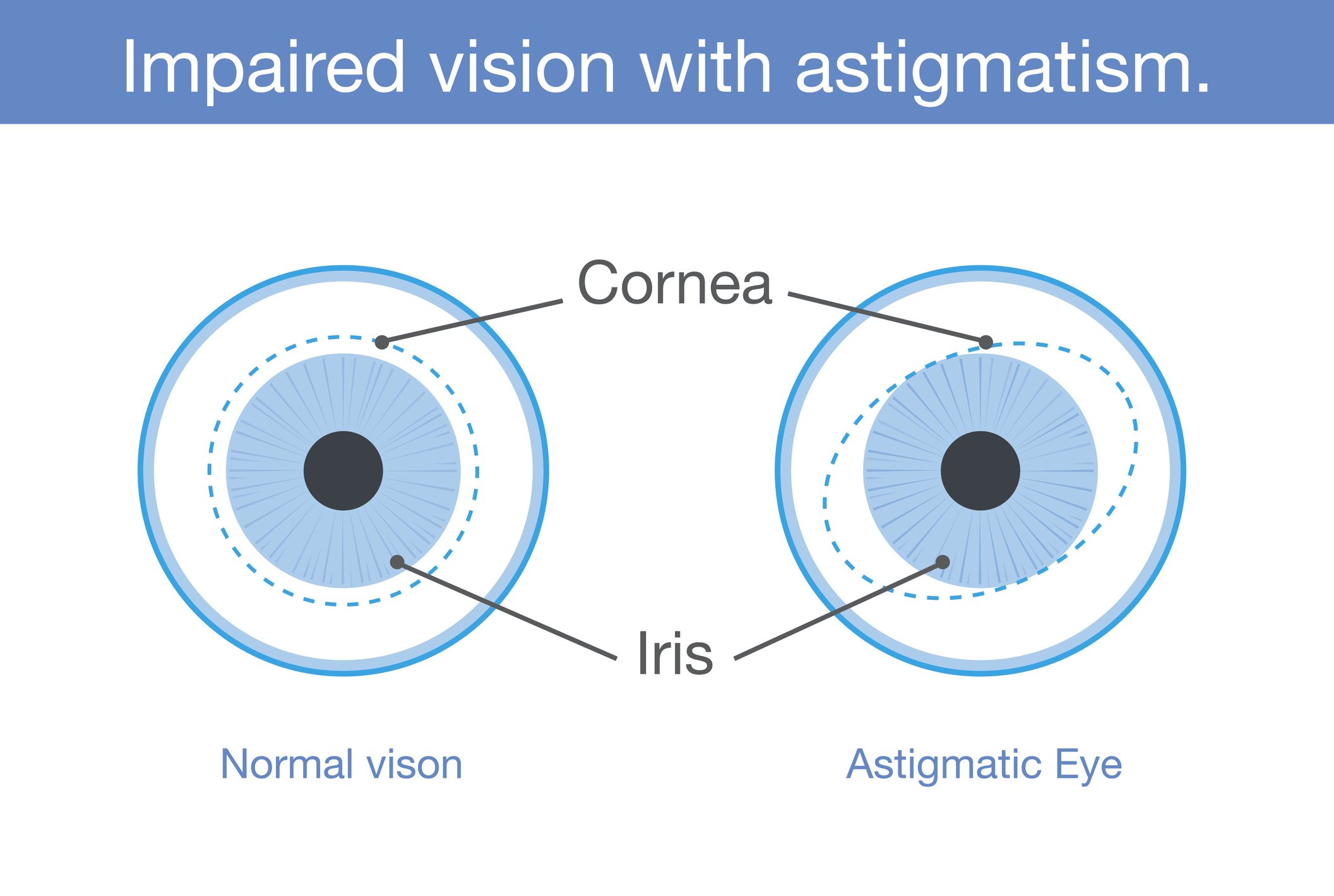 What is Astigmatism? | FramesDirect.com